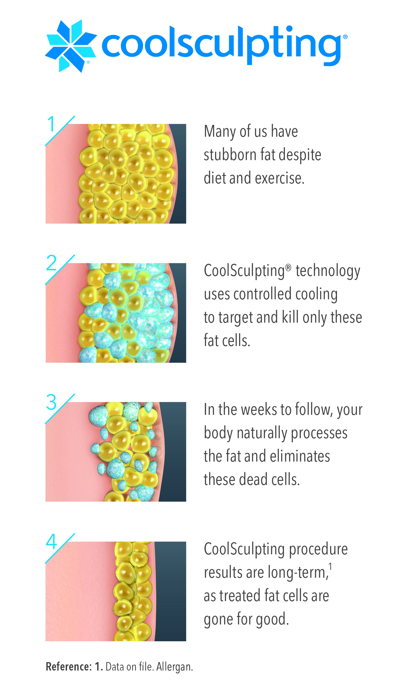 CoolSculpting – Essence Laser